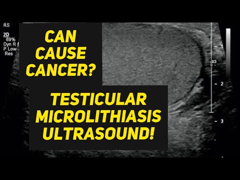 Testicular microlithiasis ultrasound - YouTube