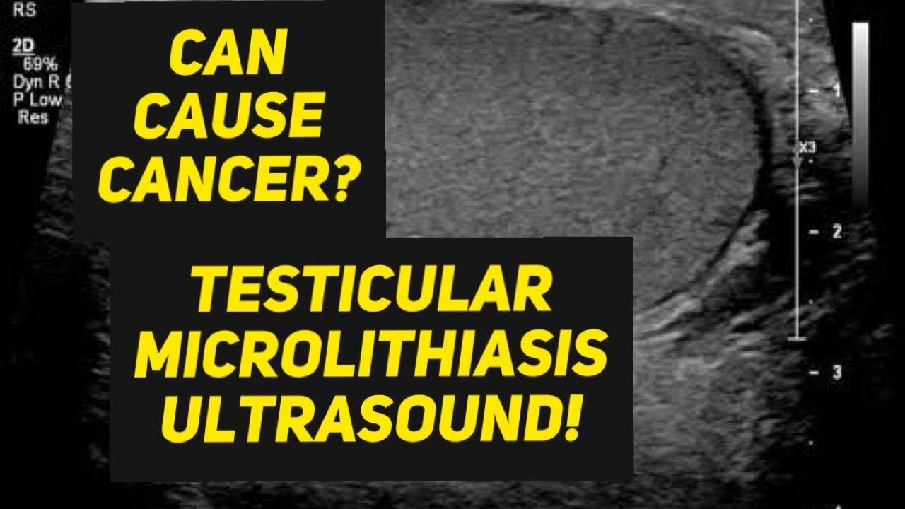 Testicular microlithiasis ultrasound - YouTube