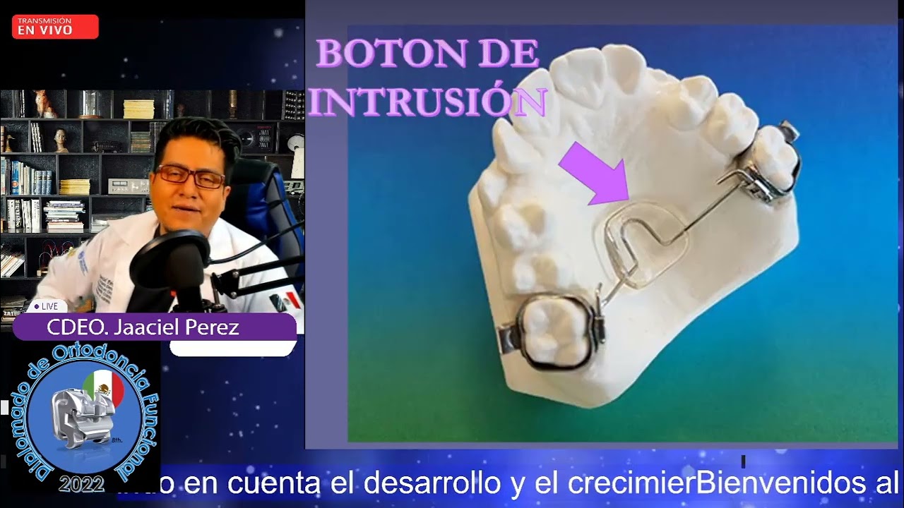Indicaciones del arco trans palatino - YouTube
