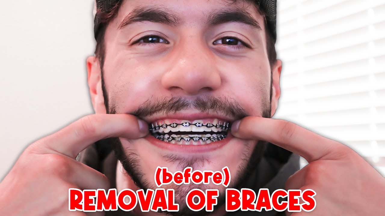 PREPARING FOR THE REMOVAL OF BRACES! - YouTube