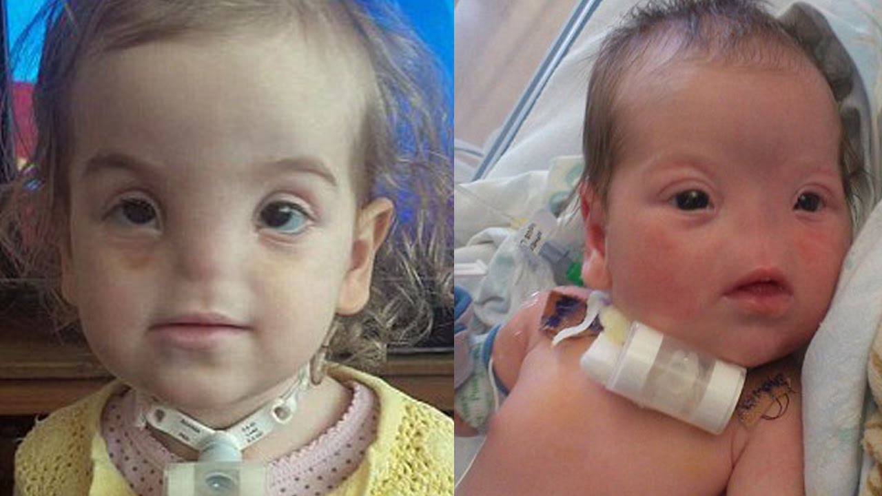 Meet The Girl Born Without A Nose - YouTube