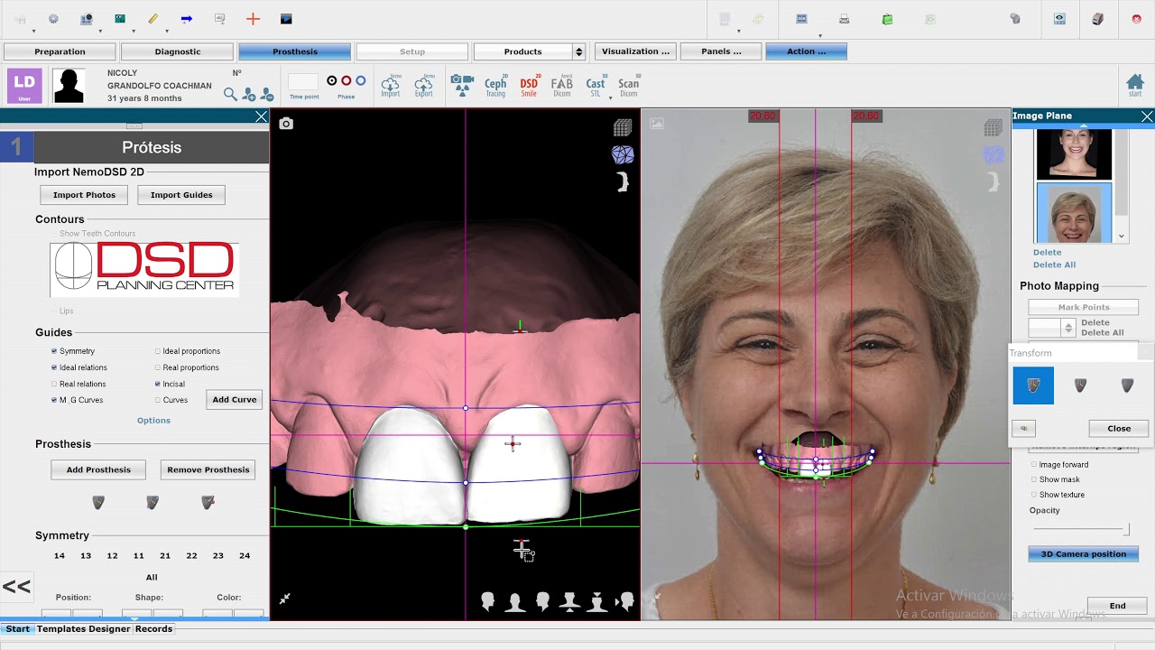 3D DSD Design After Crown Lengthening By DSD Planning Center - YouTube