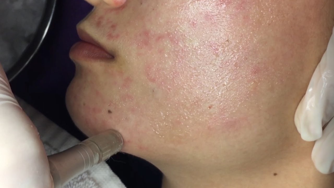 Dermaroller for Acne Scars Derma Roller #1 - Beauty Salon Stella - YouTube