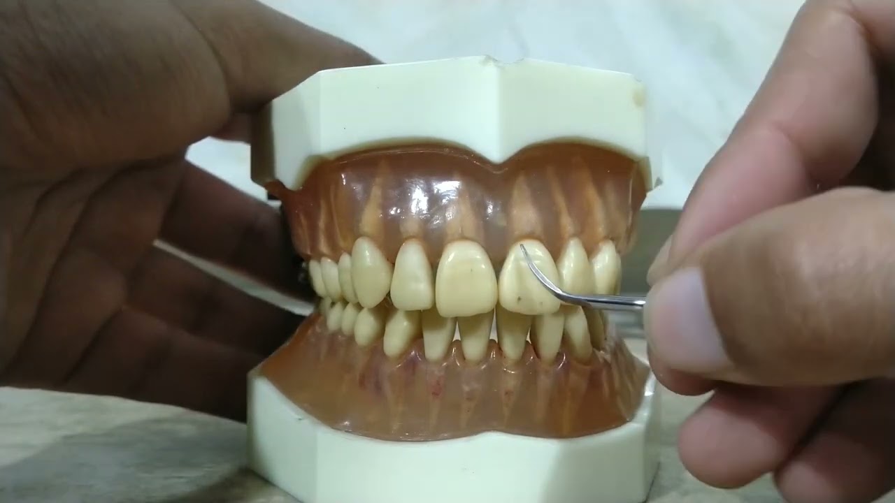 Technique For Ultrasonic Scaling - YouTube