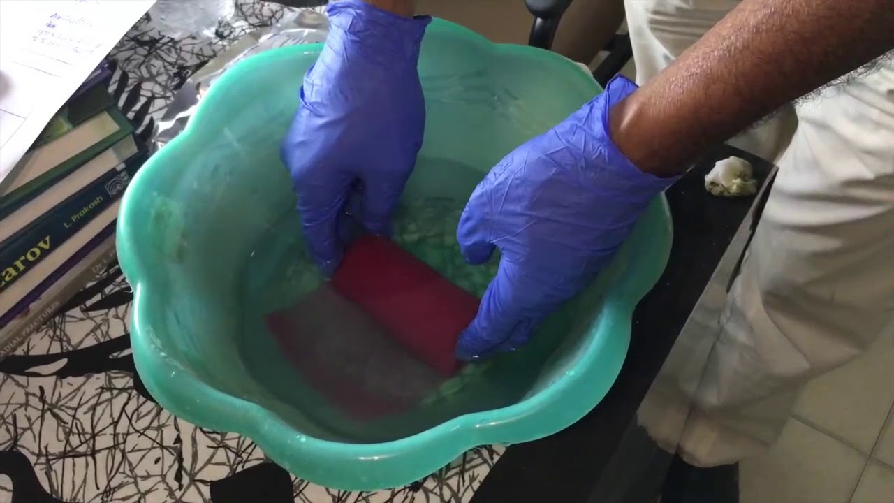 Cast bracing of femur fractures - YouTube