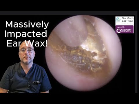 Massively Impacted Ear Wax! - Episode 76 #earwax #ear #earwaxremoval ...