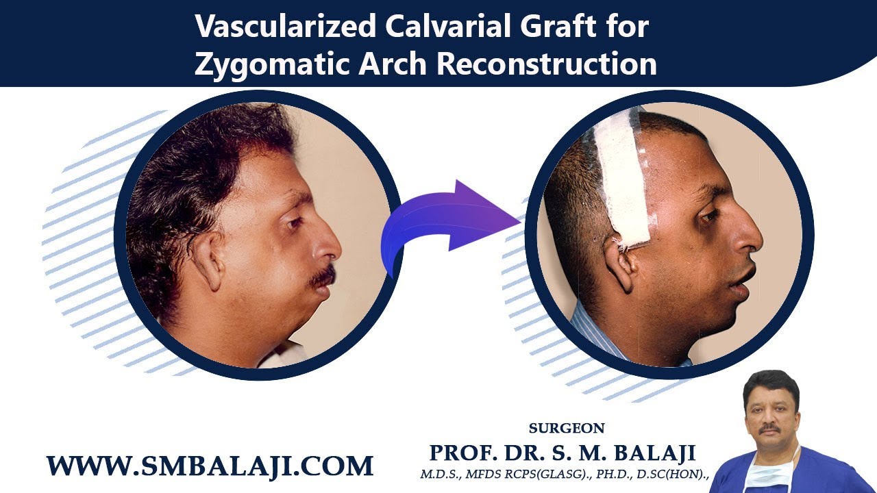 Vascularized Calvarial Graft for Zygomatic Arch Reconstruction - YouTube