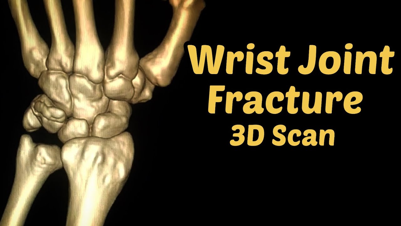 CT Scan Wrist joint 3D | Radiology |Fracture - YouTube