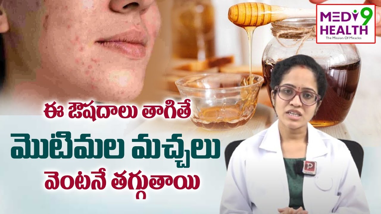 ఈ ఔషదాలు తాగితే మొటిమల మచ్చలు వెంటనే తగ్గుతాయి | Dr Madhuri Health Tips | Medi 9 Health - YouTube