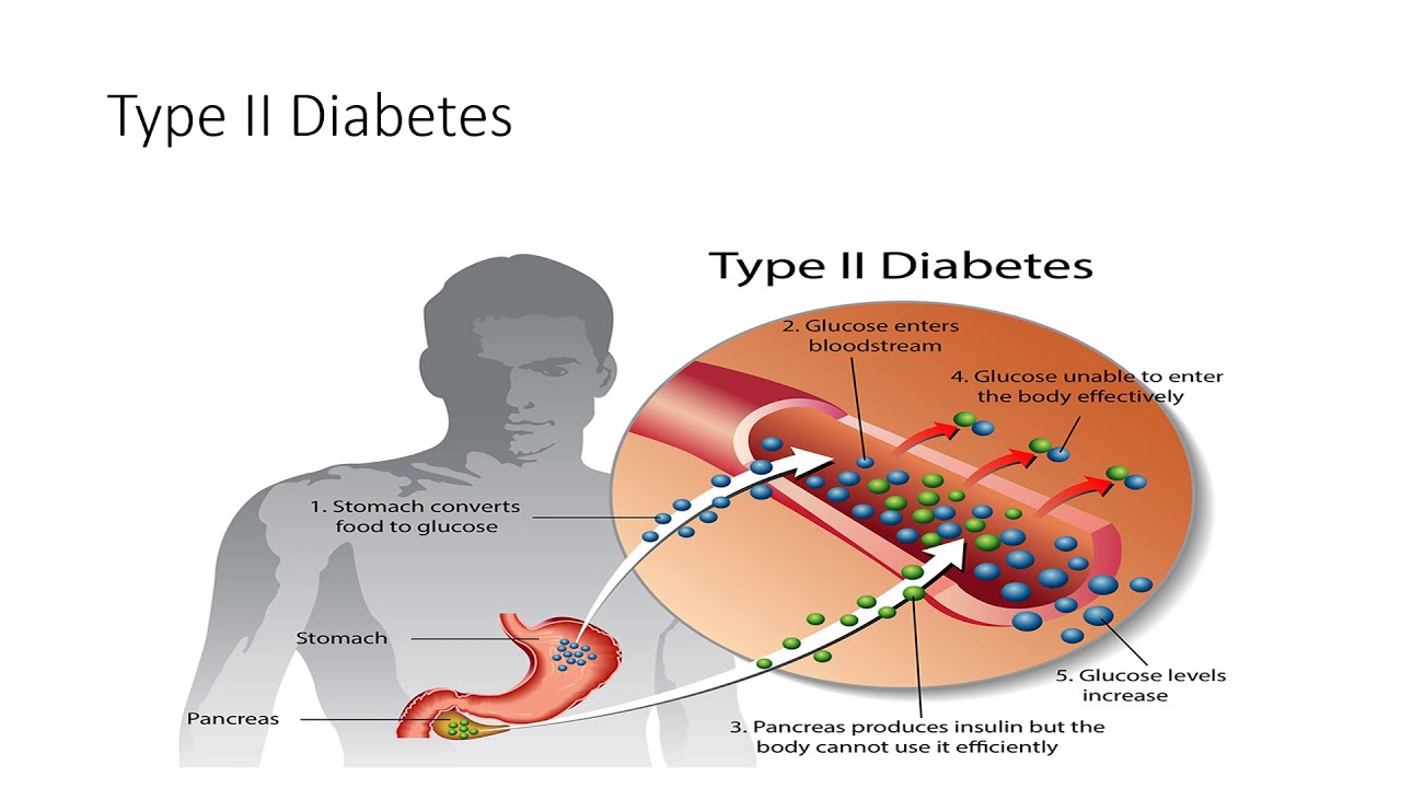 How To Control and Reverse Type 2 Diabetes - YouTube
