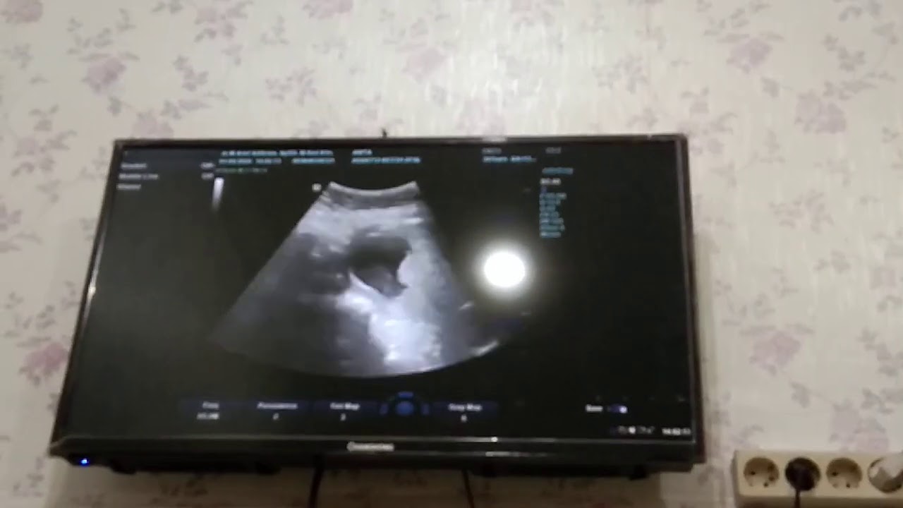 USG 13 minggu anak ke-2 - YouTube