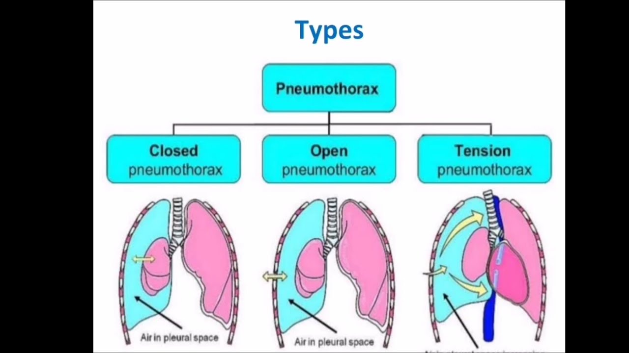 open vs closed vs tension pneumothorax - YouTube