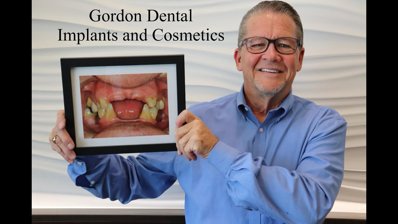 Full Mouth Dental Implants in Kansas City MO: Patient Reviews and ...