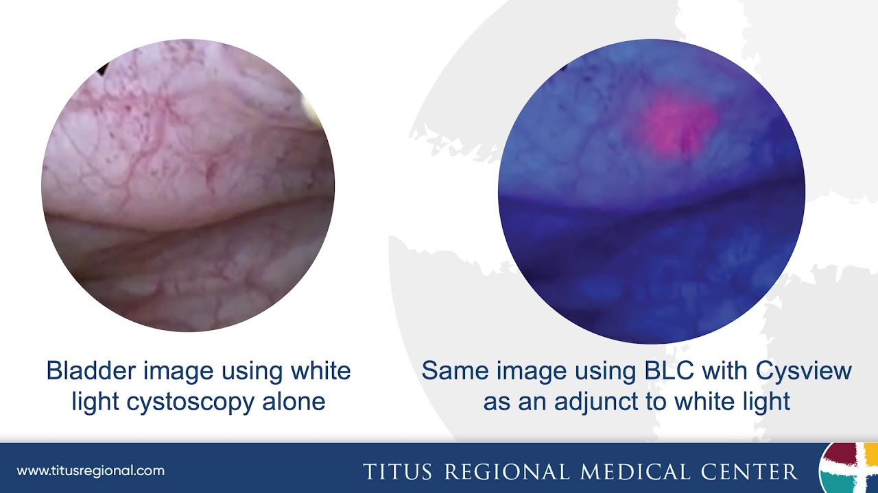 Blue Light Cystoscopy with Cysview - Advanced Urology Institute