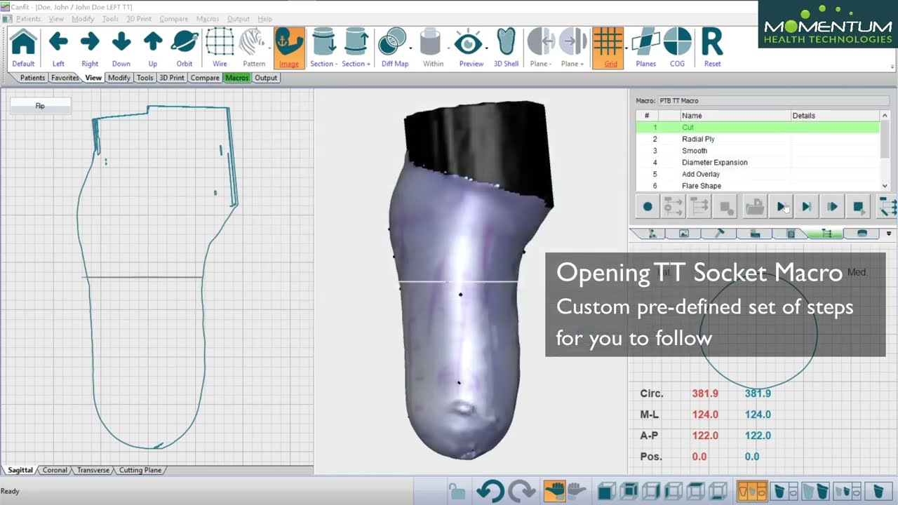 2 Minute Trans-tibial Socket Modification with a Canfit Macro - YouTube
