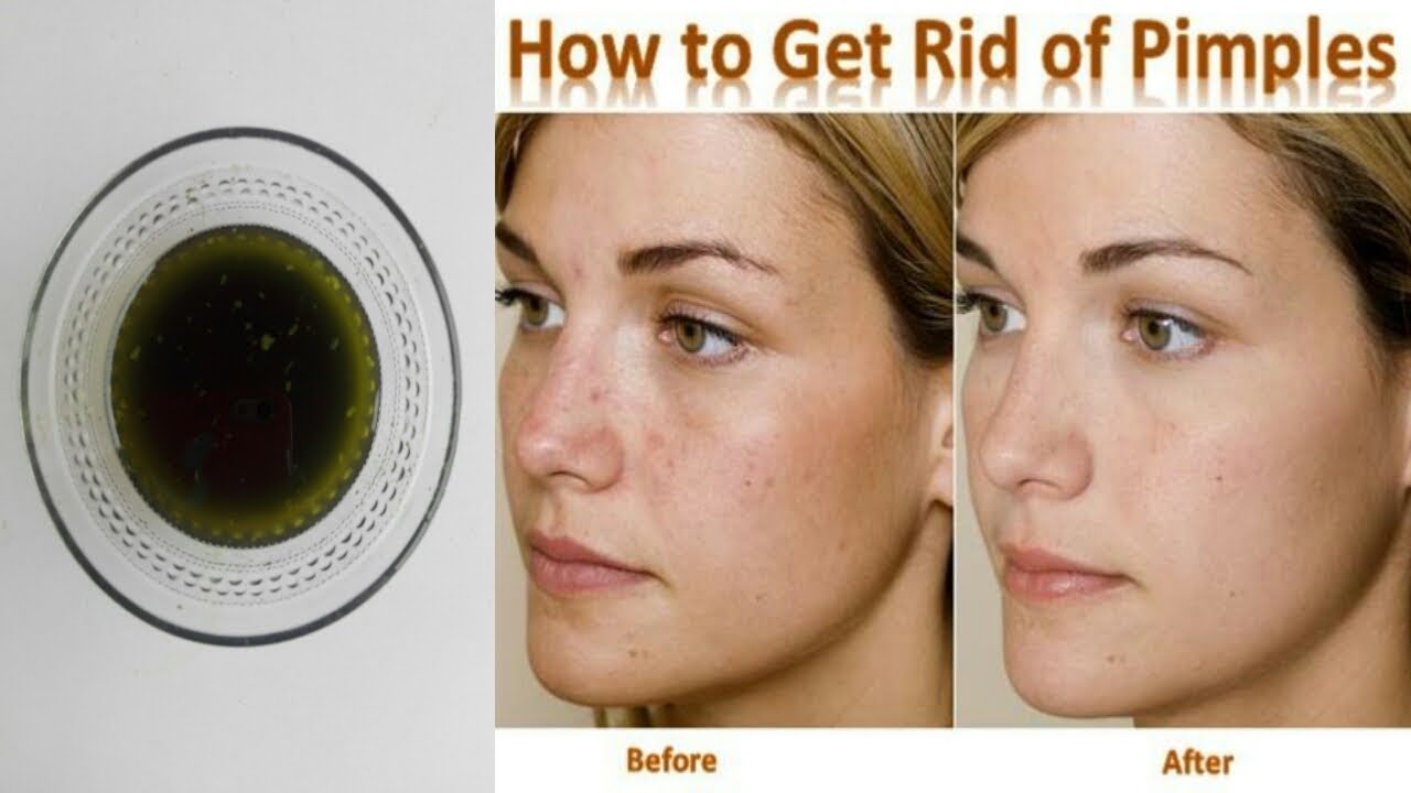 How to remove pimples easily at home - YouTube