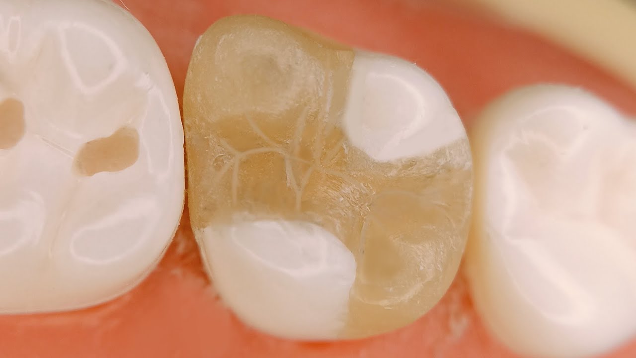 Upper 7 ((Complex cavity , composite filling restoration)) - YouTube