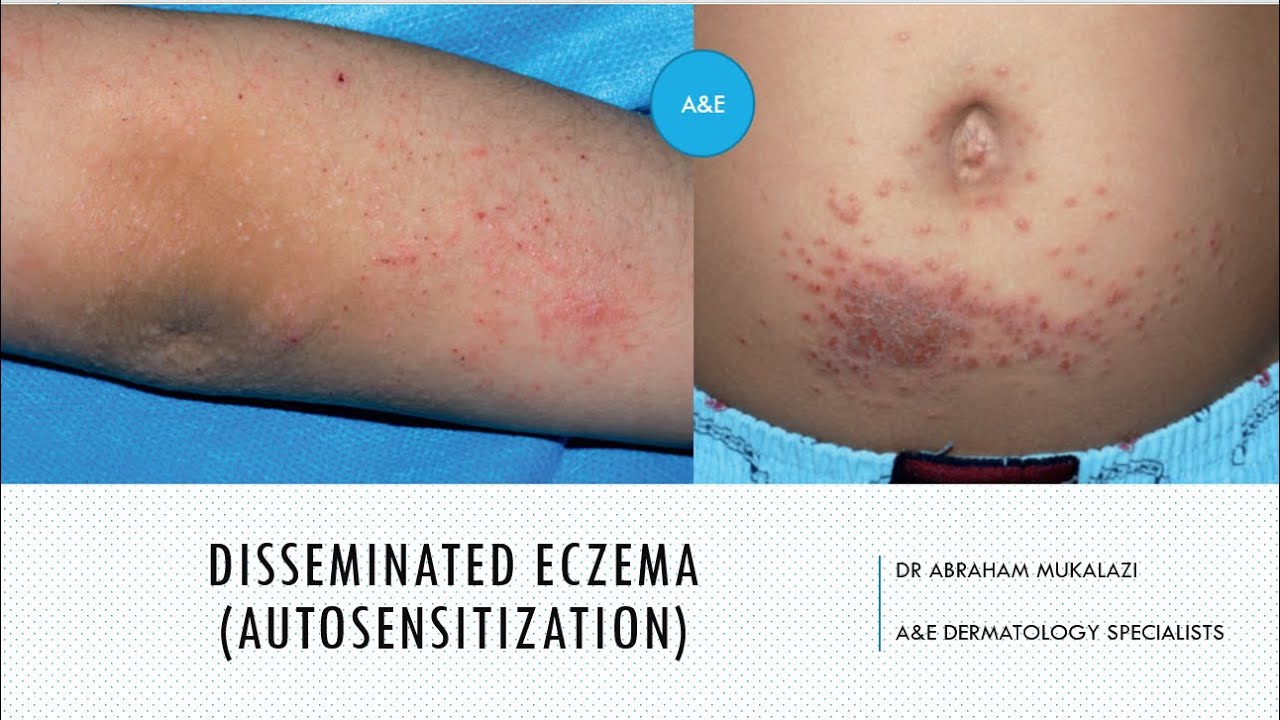 DISSEMINATED ECZEMA (ID REACTION ) EXPLAINED BY DR ABRAHAM #dermatology ...