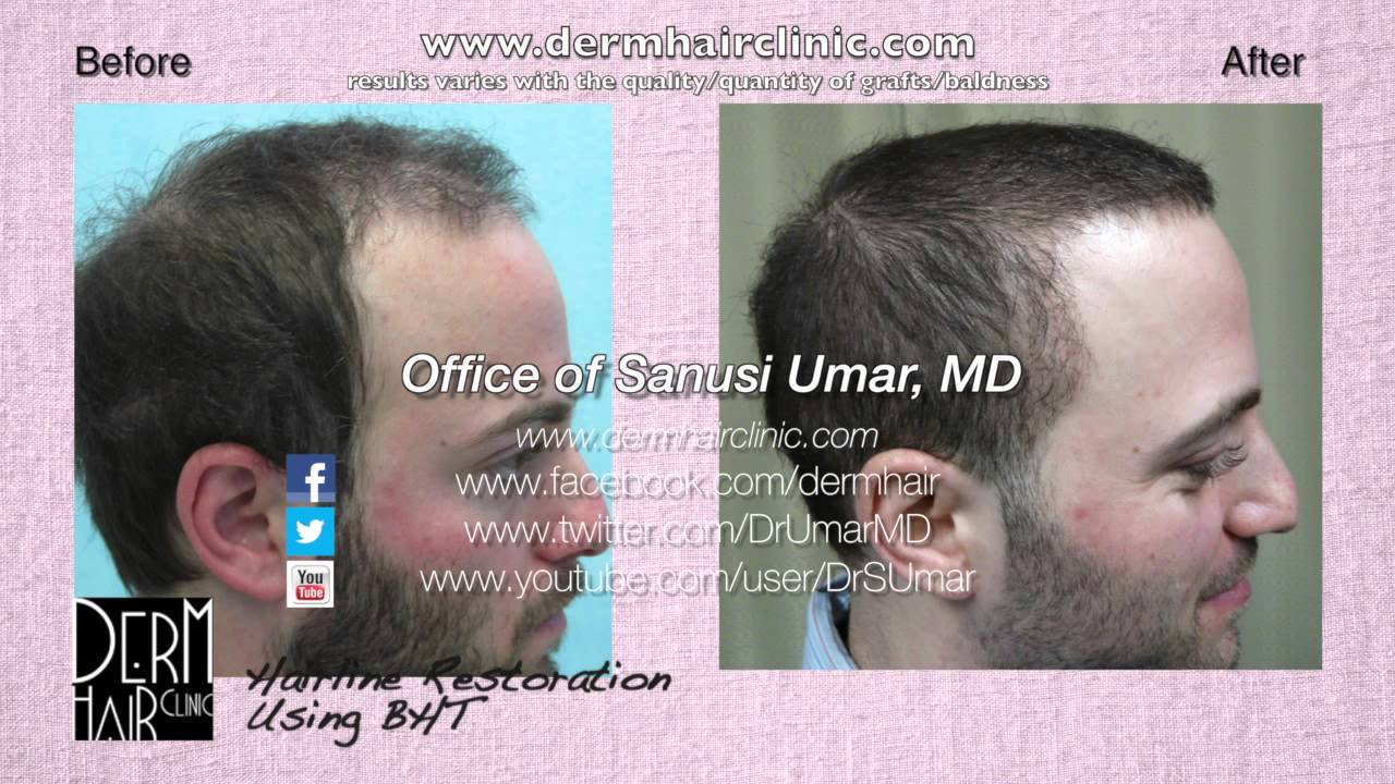 Patient Can Finally Wear Short, Classic Hair Style After His Strip Surgery Repair By Dr.U - YouTube