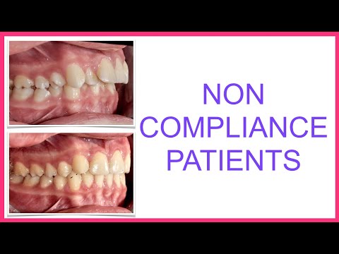 Fixed orthodontic non compliance patient 🎲 tips and tricks 🎲 - YouTube