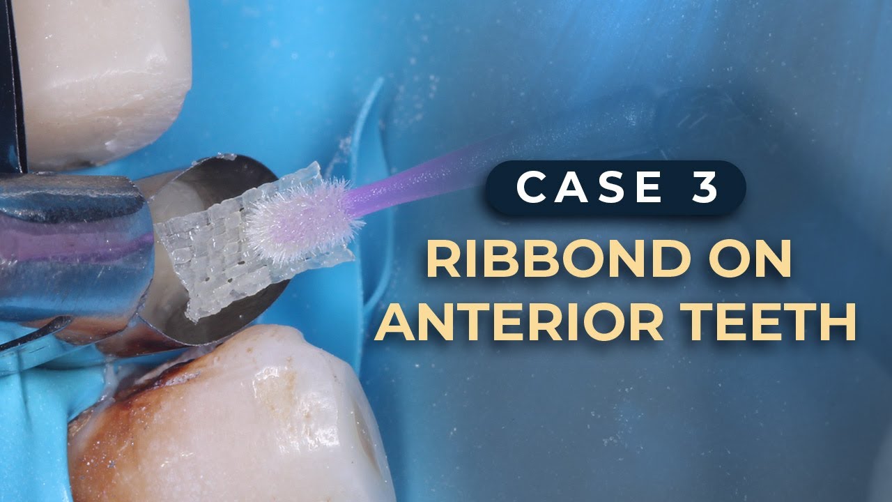 How to save anterior teeth with Ribbond & Emax Crowns - Case 3 - YouTube