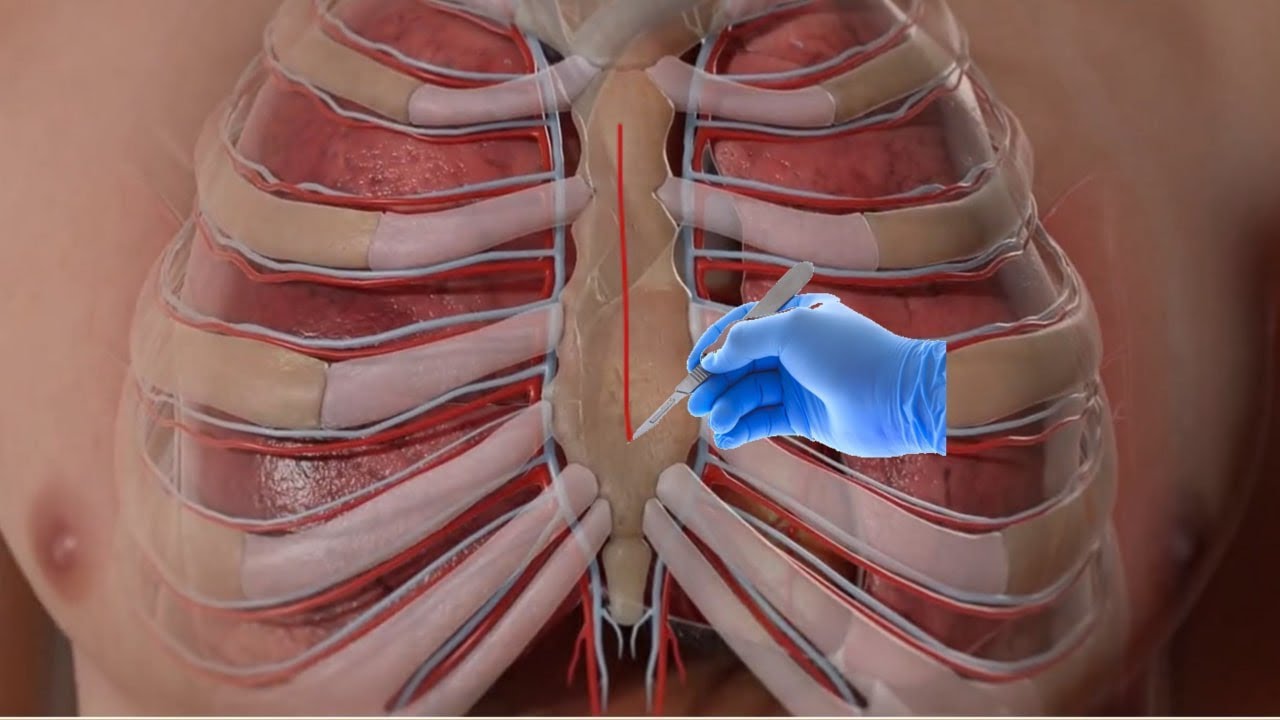 Heart Bypass Surgery (CABG): Procedure, Recovery, and Benefits| Heart Surgery 3D Animation - YouTube