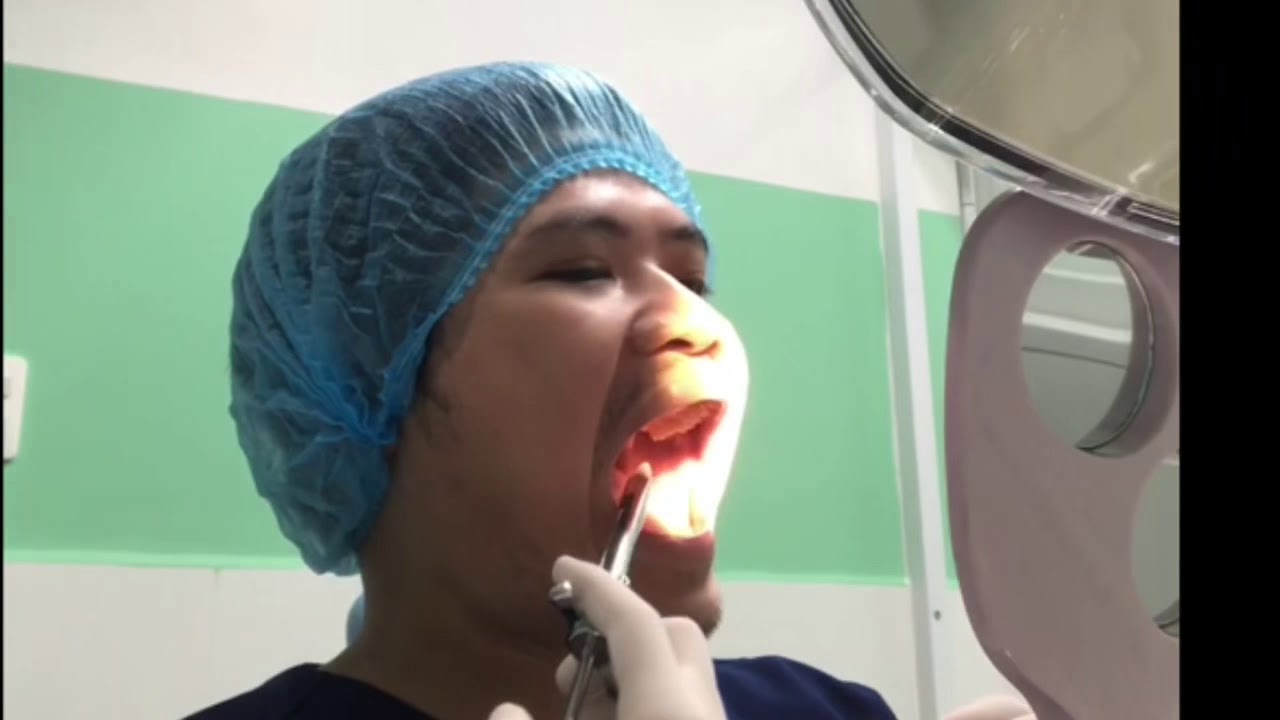 Self-extraction of an upper left wisdom tooth. - YouTube