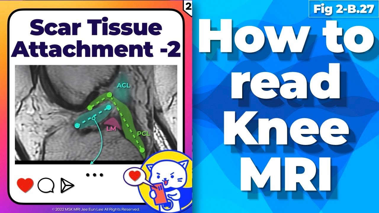 (Fig 2-B.27) Scar tissue Attachment to the PCL - YouTube