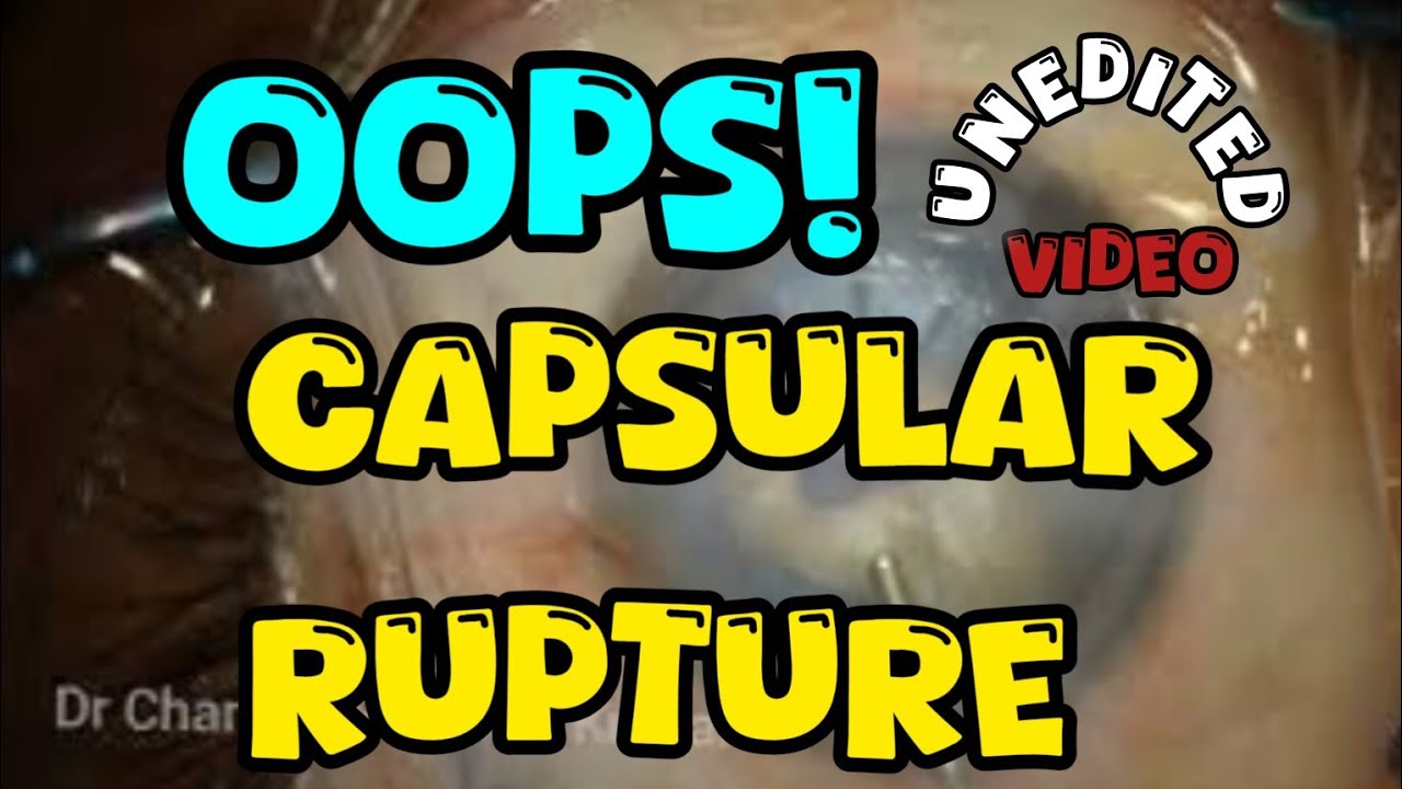 how to approach a intumescent catarct when there is capsular rupture ...