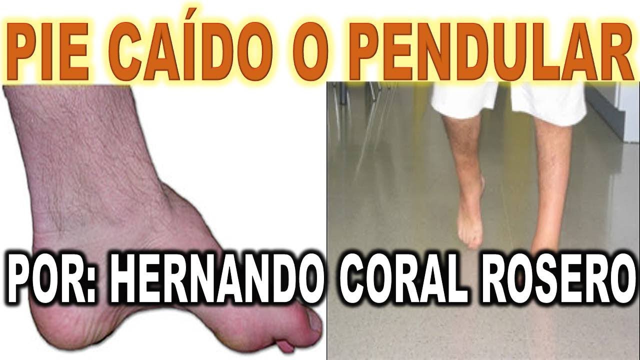 PIE CAÍDO O PENDULAR - TRASTORNO NEUROMUSCULAR - YouTube