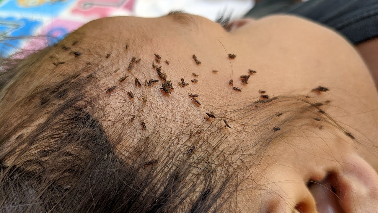 how to remove lice step by step from brown hair - Remove all big lice ...