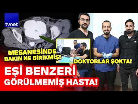 İdrar kanalı ve mesanesinden çıkan o şey doktorların ağzını açık bıraktı! Yıllarca bununla yaşamış!