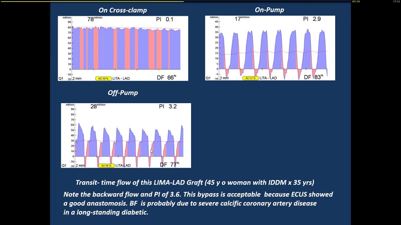 The flow meter can be your best friend - YouTube