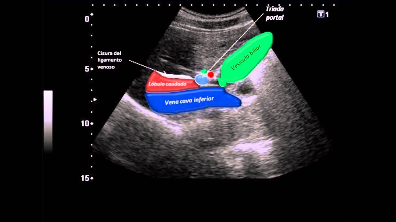 Vídeo 4 Corte longitudinal en linea medioclavicular derecha - YouTube