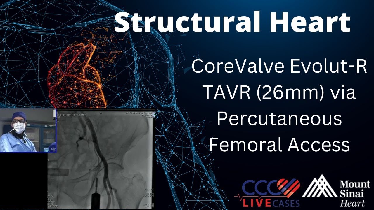 CoreValve Evolut-R TAVR (26mm) via Percutaneous Femoral Access ...