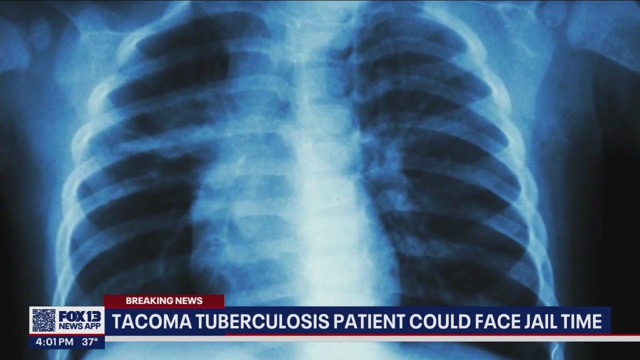 Woman with tuberculosis in Tacoma refusing treatment, could face jail ...