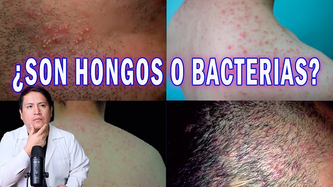 ¿Cómo saber si mi foliculitis es por hongos o por bacterias? 🦠🦠🦠 - YouTube