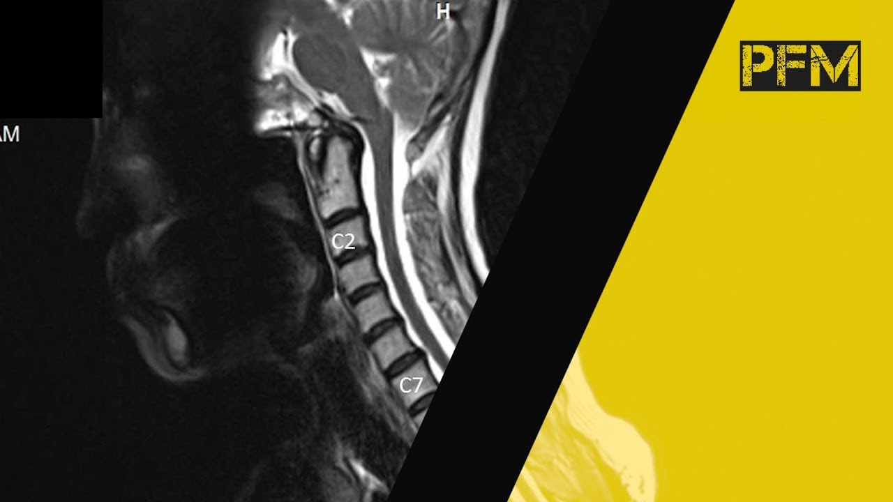 Should I Have an MRI? - PainFree Maverick Brooklyn - YouTube