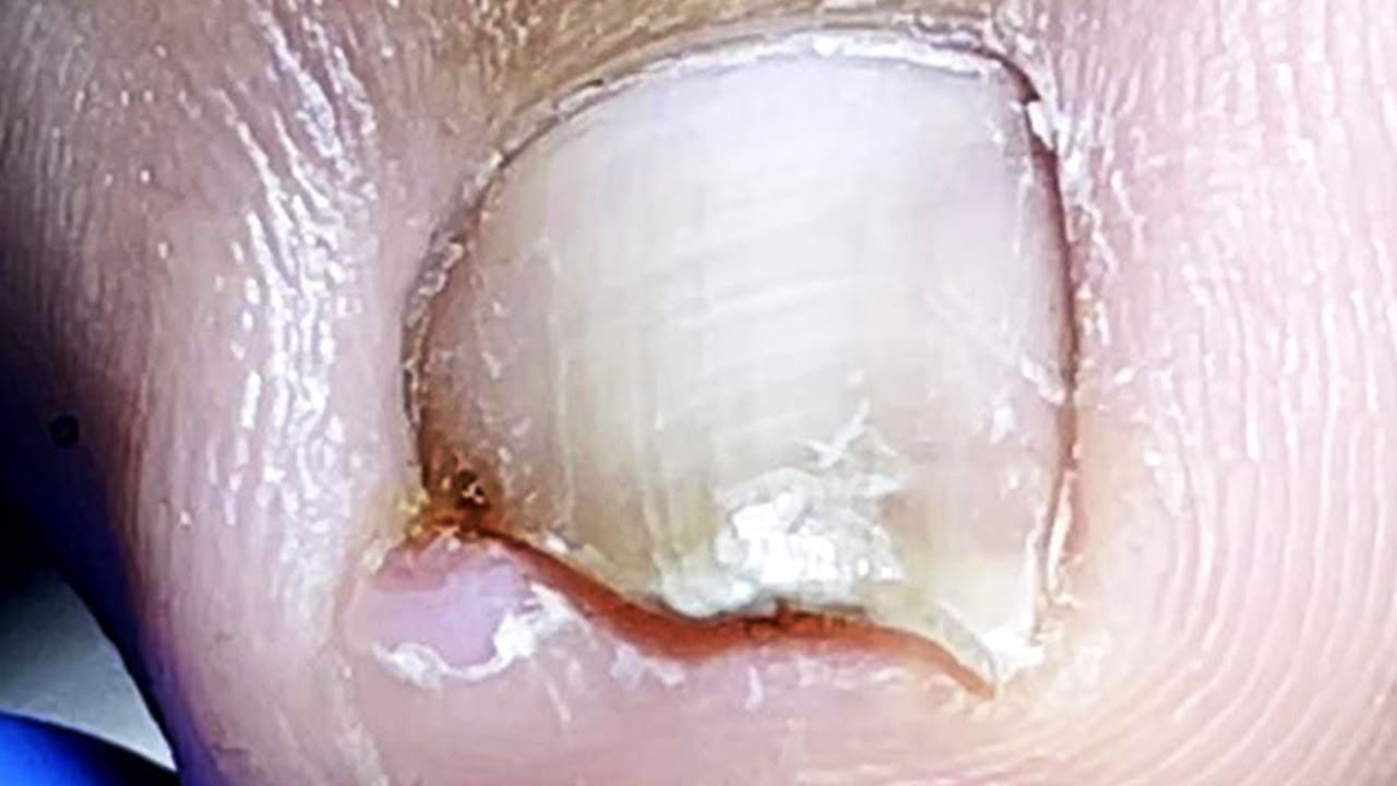 The ingrown toenail on one side breaks deep into the toenail #pedicure ...