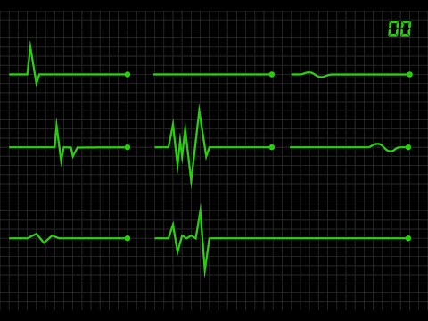 HOW A HEART BEAT FLAT LINE LOOKS LIKE. || ECG flat line