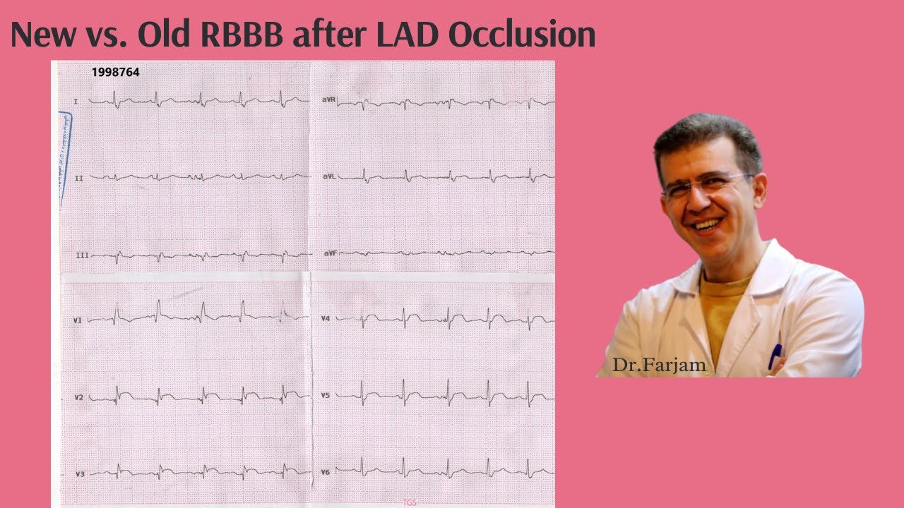 New vs. Old RBBB after LAD Occlusion, Clinical Considerations - YouTube