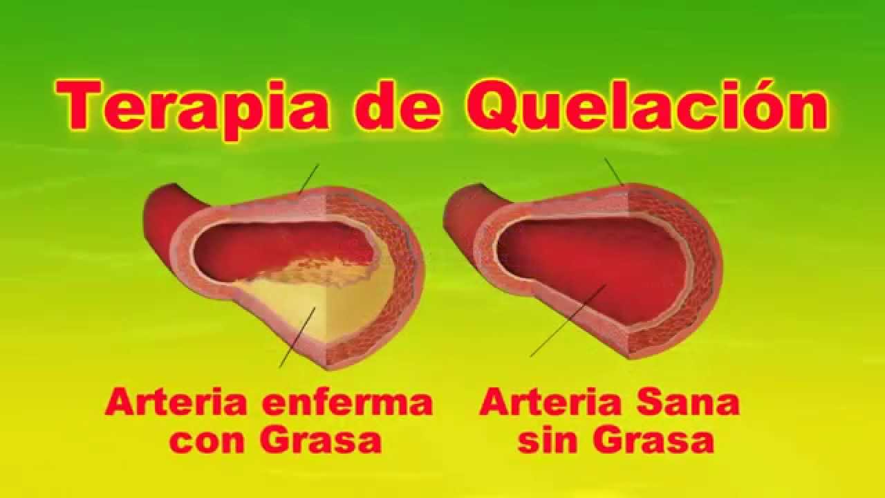 Terapia de Quelación - YouTube