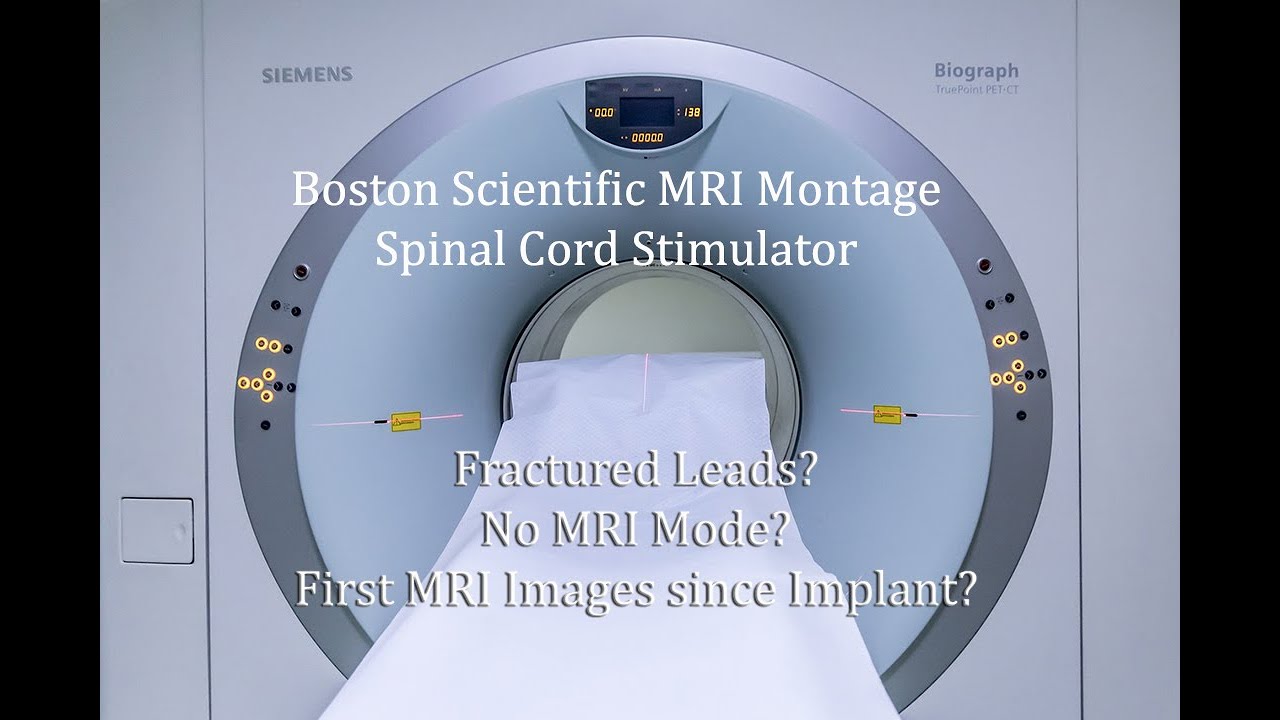 First MRI Images Since Implant? Fractured Leads? No MRI Mode? - YouTube