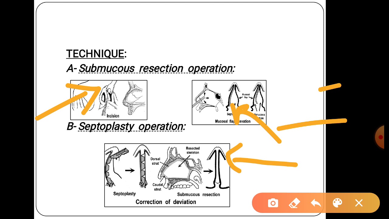 5 rhinologic procedures - YouTube