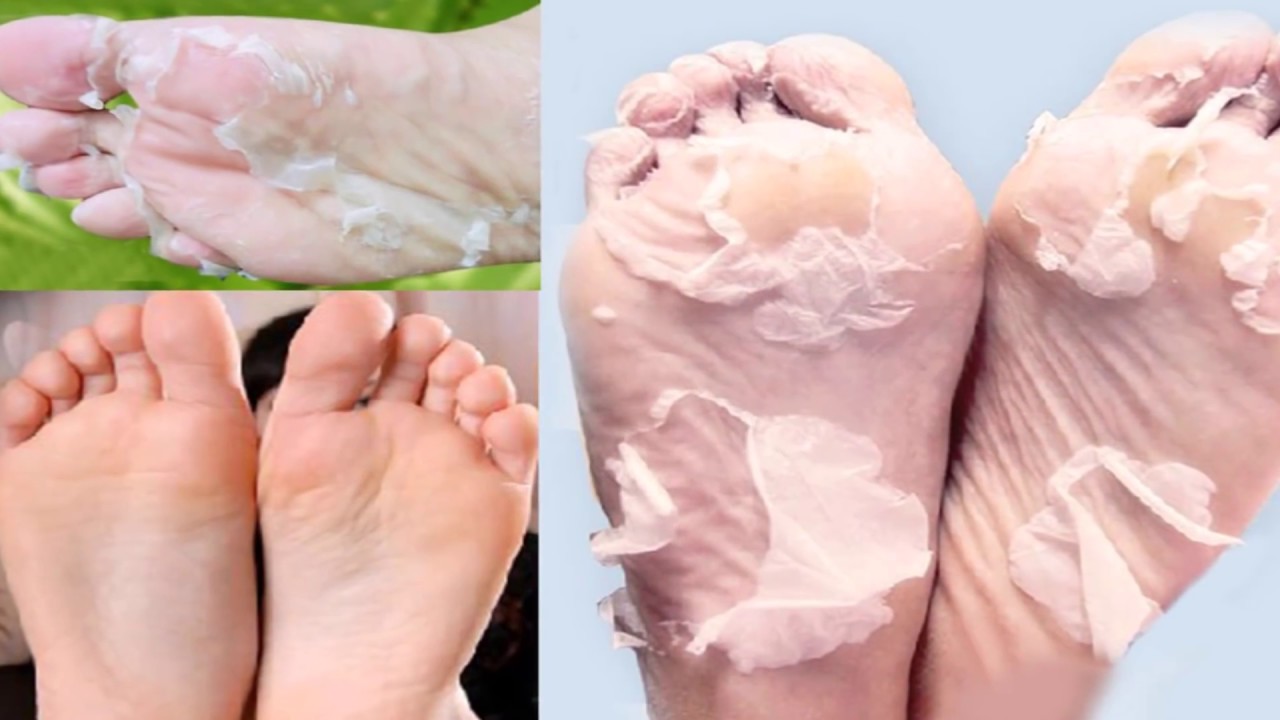 Skin Facts! Warning, Picking and Peeling - YouTube