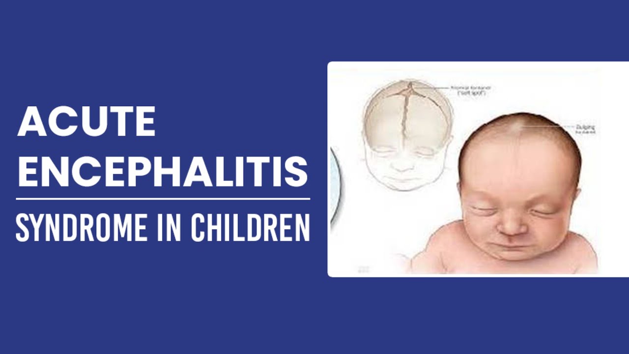 Acute encephalitis syndrome in children - zoom discussion - YouTube