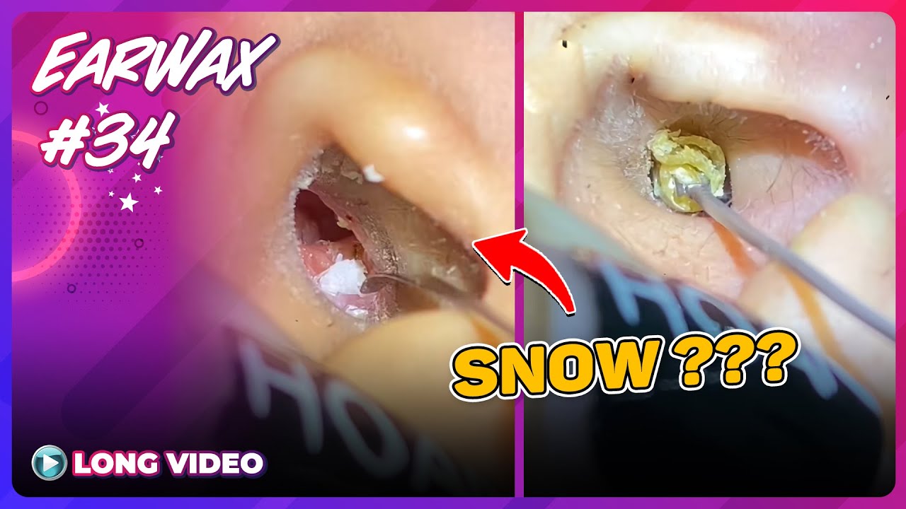 EP 34 Earwax ASMR. Compilation of the craziest earwaxing times - YouTube