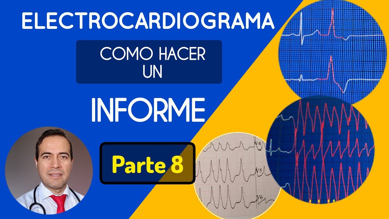 COMO REALIZAR INFORME DE ELECTROCARDIOGRAMA PARTE 8 - YouTube