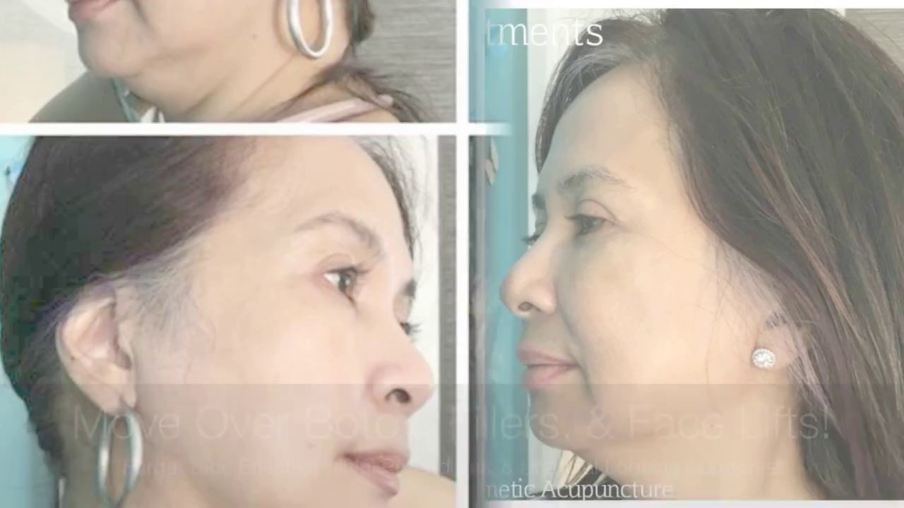 San Diego Cosmetic Acupuncture And Micro-Needling With Stem Cells - YouTube