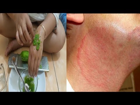 Penyakit Kulit Menahun, Gatal2 Kudis Kadas Kurap Jadi Luntur Dengan ...